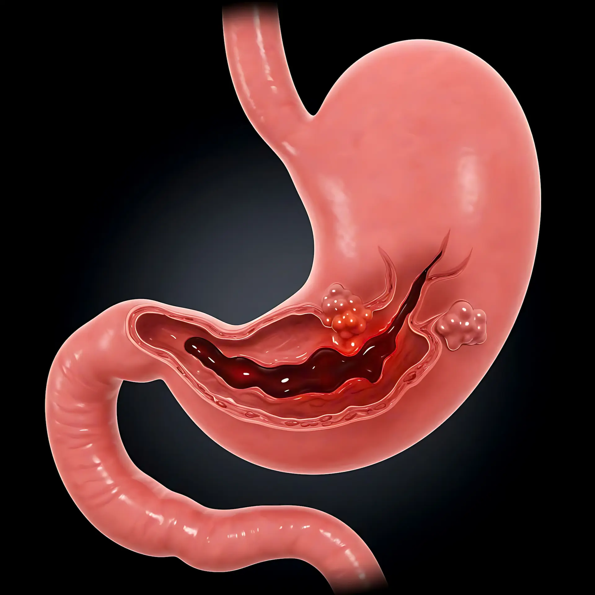 Stopping Stomach Ulcer Bleeding: Injection vs Mechanical Clipping